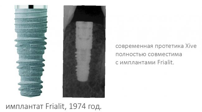 Рекомендации по установке имплантатов. Часть VII. XiVE. - IMPLANT-IN ...